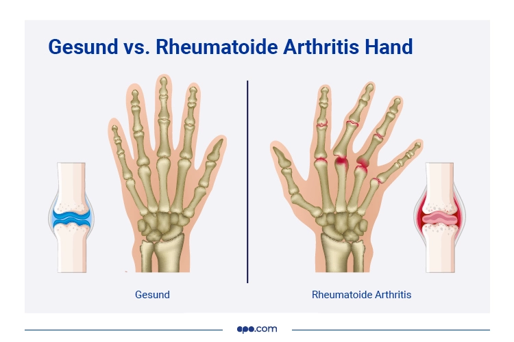 Rheuma in den Fingern: Symptome & Tipps für den Alltag