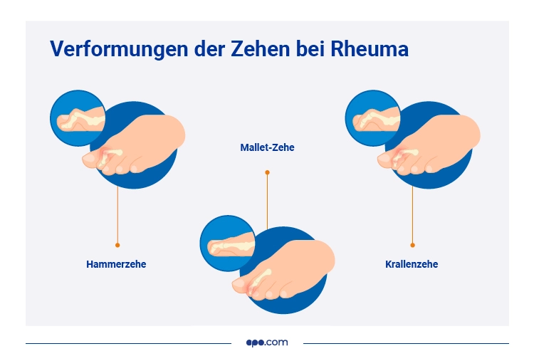 Rheuma Symptome Beine: So managen Sie Ihre Beschwerden