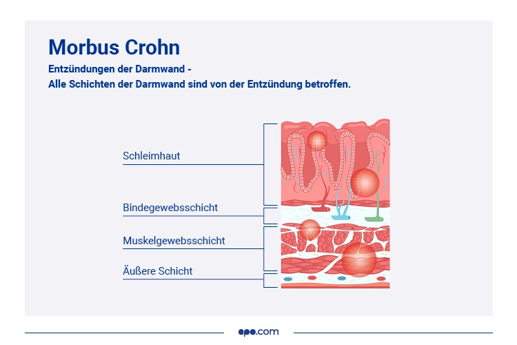 Was ist Morbus Crohn? Alles zur chronischen Darmerkrankung